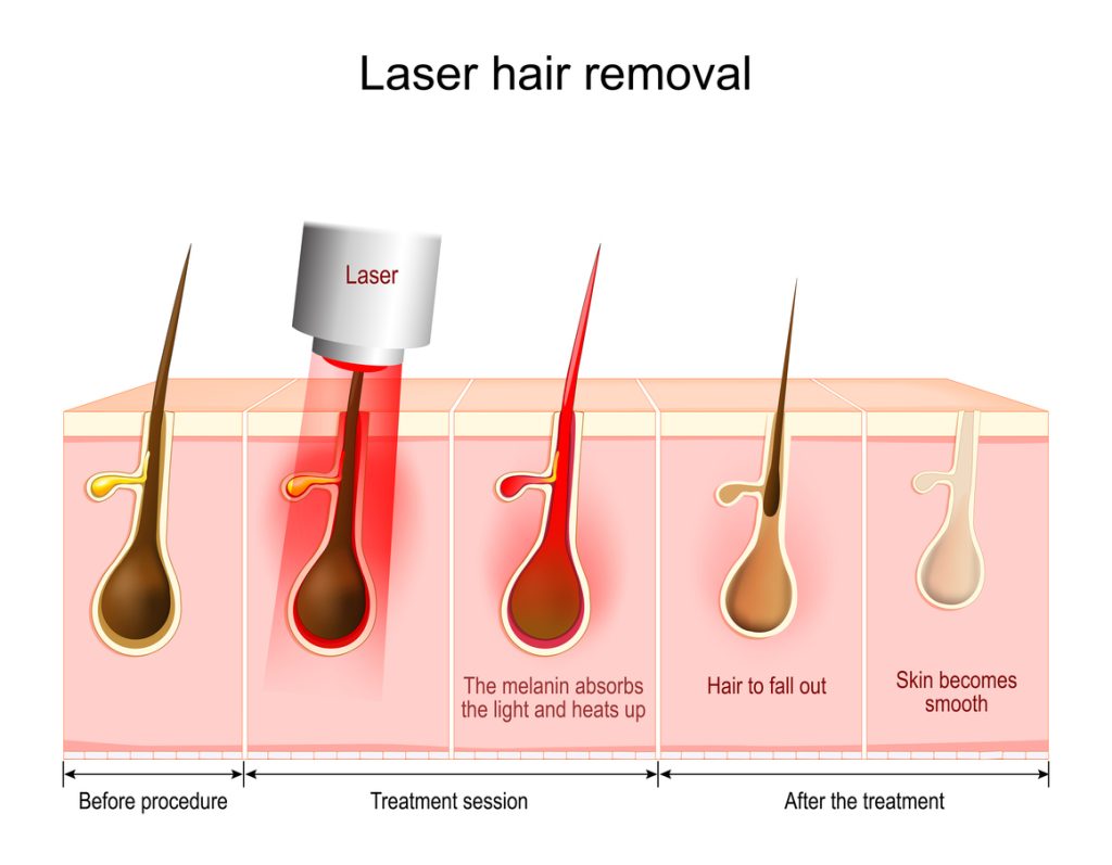 Laser Hair Removal Alaxis Medical Aesthetic Surgery